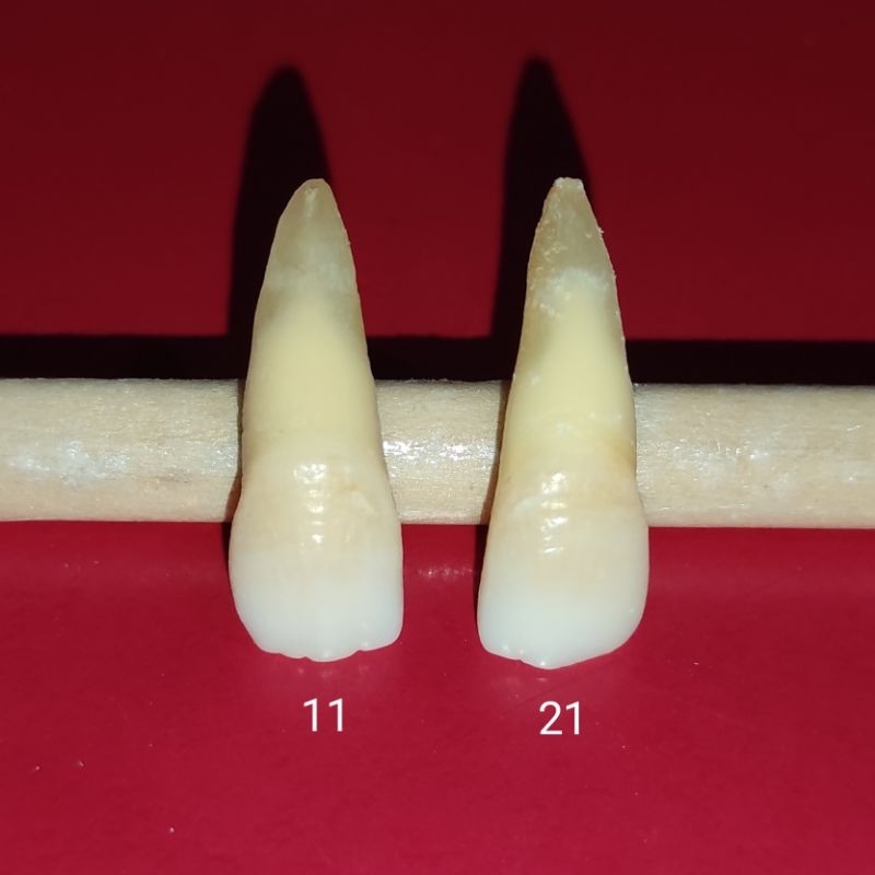 Jual Gigi Insisif Sentral Identik Rahang Atas (Gigi 11 & Gigi 21 ...
