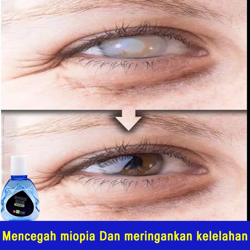 Jual Obat mata Pengobatan Astigmatisme Miopia Floaters Presbiopia ...