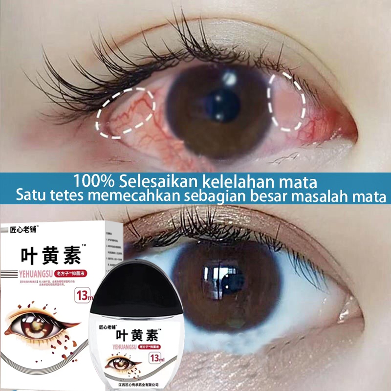 Jual Obat Mata Berlemak Kekuningan Penyakit Pterigium Glukoma Katarak Ada Selaput di Bagian ...