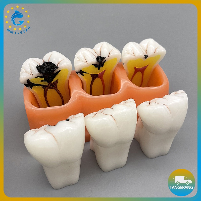 Jual Caries Dental Mode 4X/Model Study Anatomi Gigi Caries/Model Karies ...
