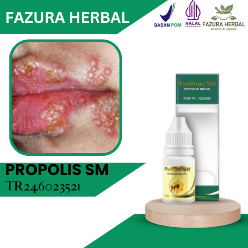 Jual Propolis SM - Obat Herpes Bibir, Obat Herpes Labialis, Obat ...