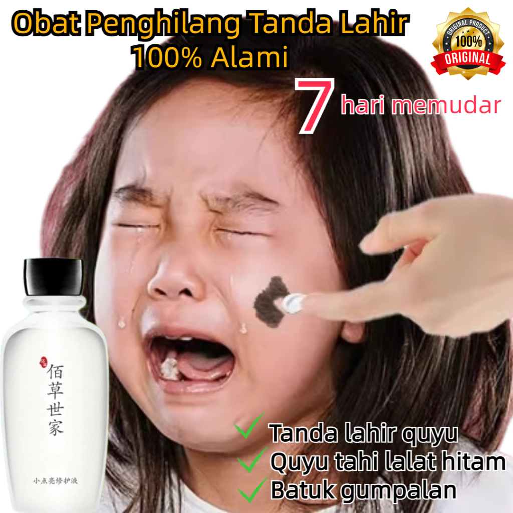 Jual Penghilang tanda lahir Orang dewasa dan bayi menghilangkan tanda ...
