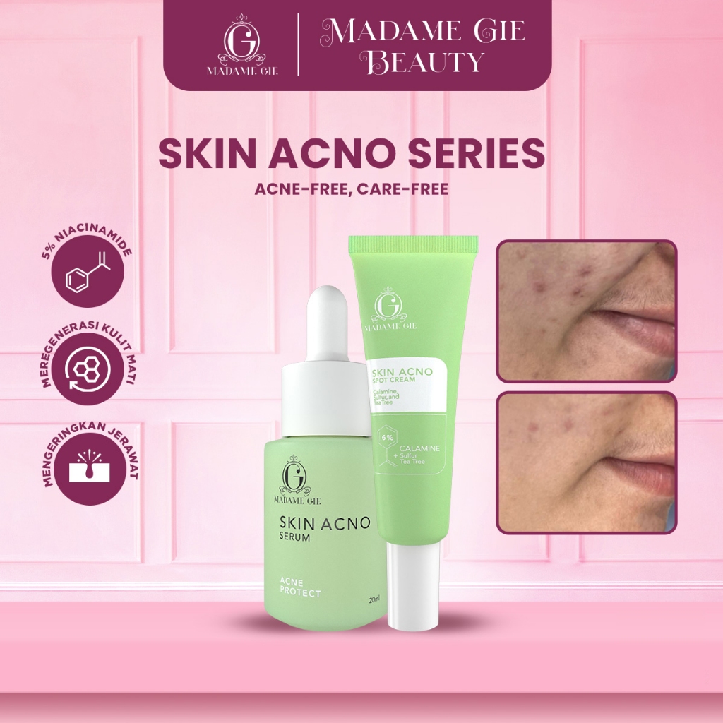 Jual Madame Gie Skin Acno Series - Cream Serum Jerawat | Shopee Indonesia