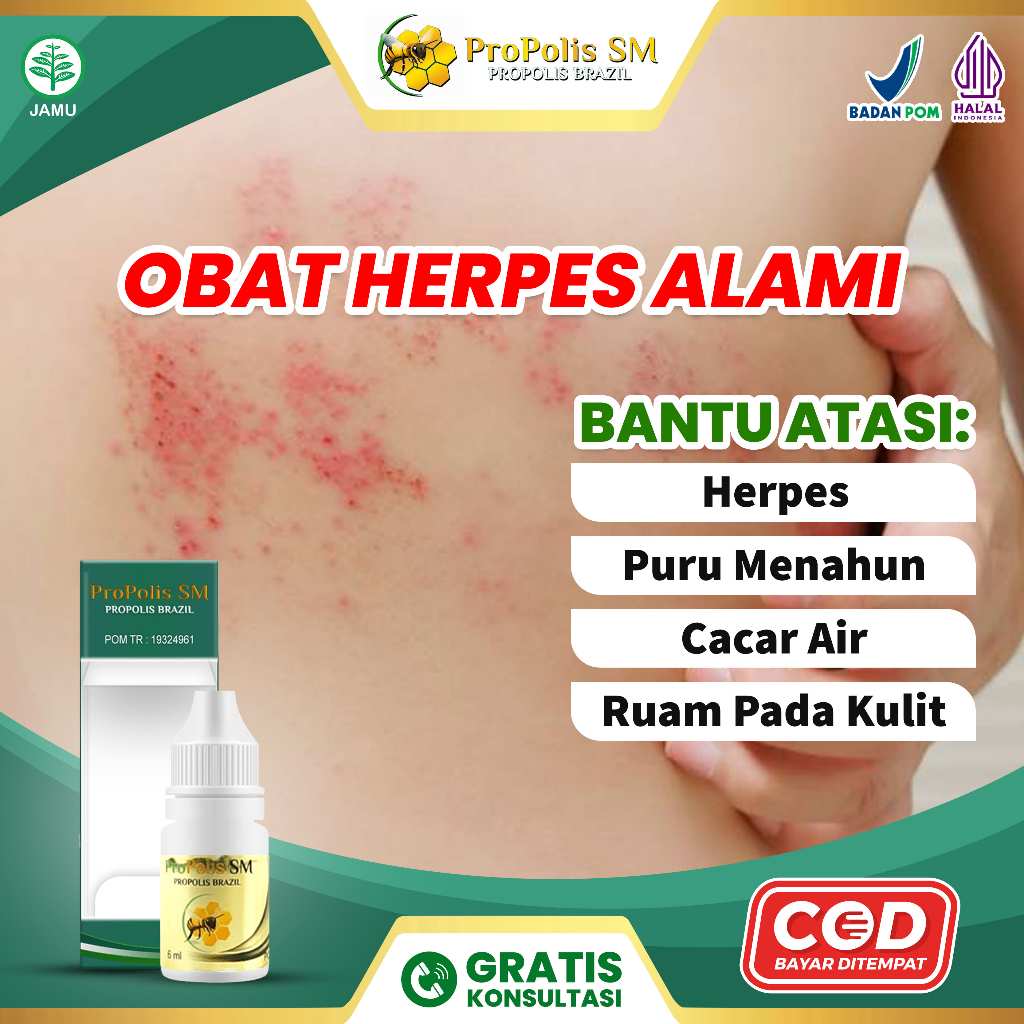 Jual Obat Herpes Zoster, Herpes Genital, Gatal Herpes, Salep Obat ...