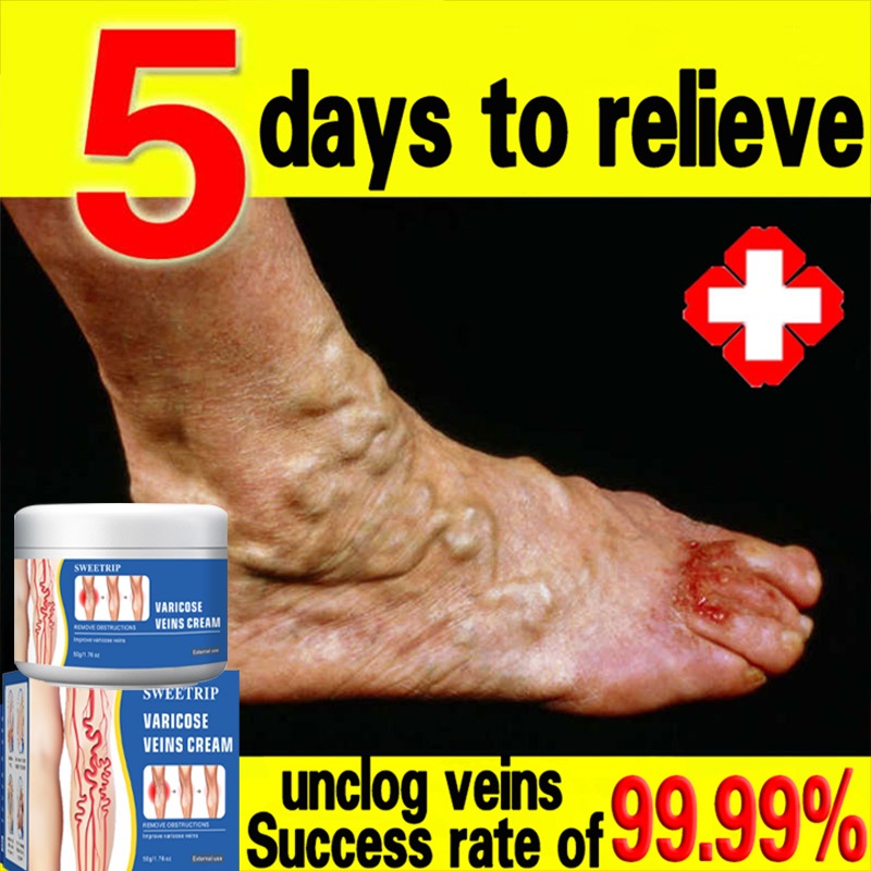 Jual SWEETRIP Varicose Veins Cream Obat Varises di kaki dan betis ...