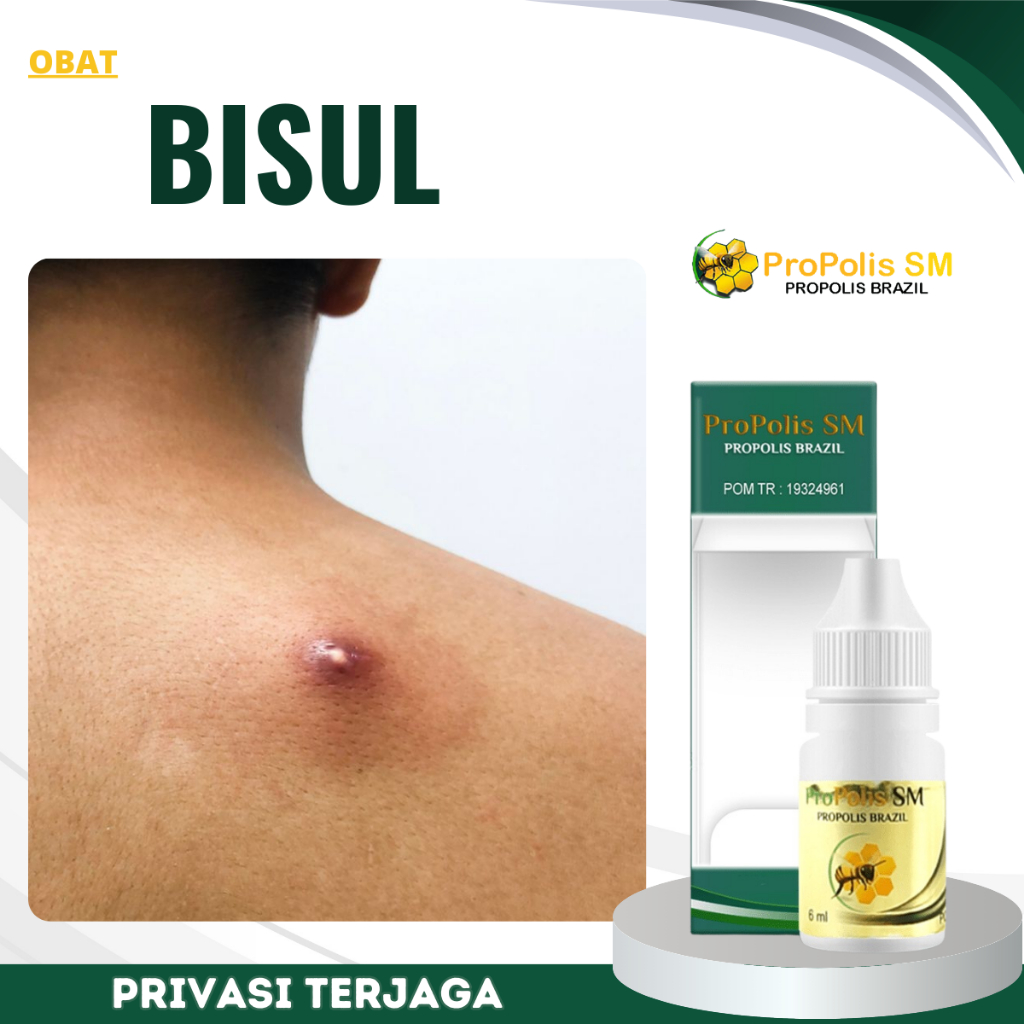 Jual Obat Bisul, Obat Bisul Bernanah, Obat Bisul Bayi Anak Dan Dewasa ...