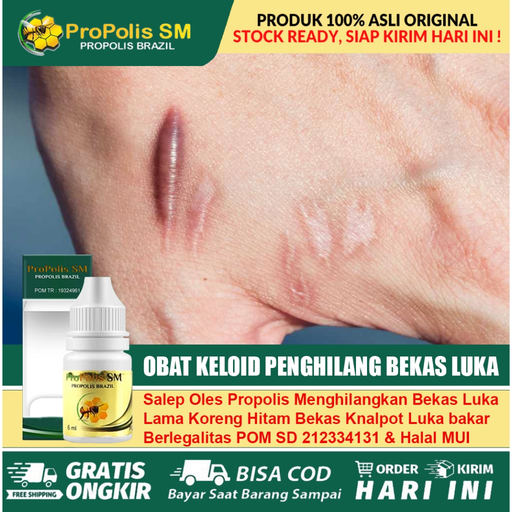 Jual Obat Keloid, Daging Tumbuh, Penumpas Daging Tumbuh, Pengempis ...