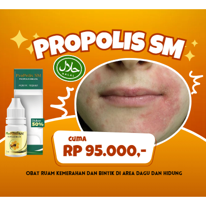 Jual Obat Gatal - Gatel Menghilangkan Dermatitis kontak, jamur, Infeksi ...