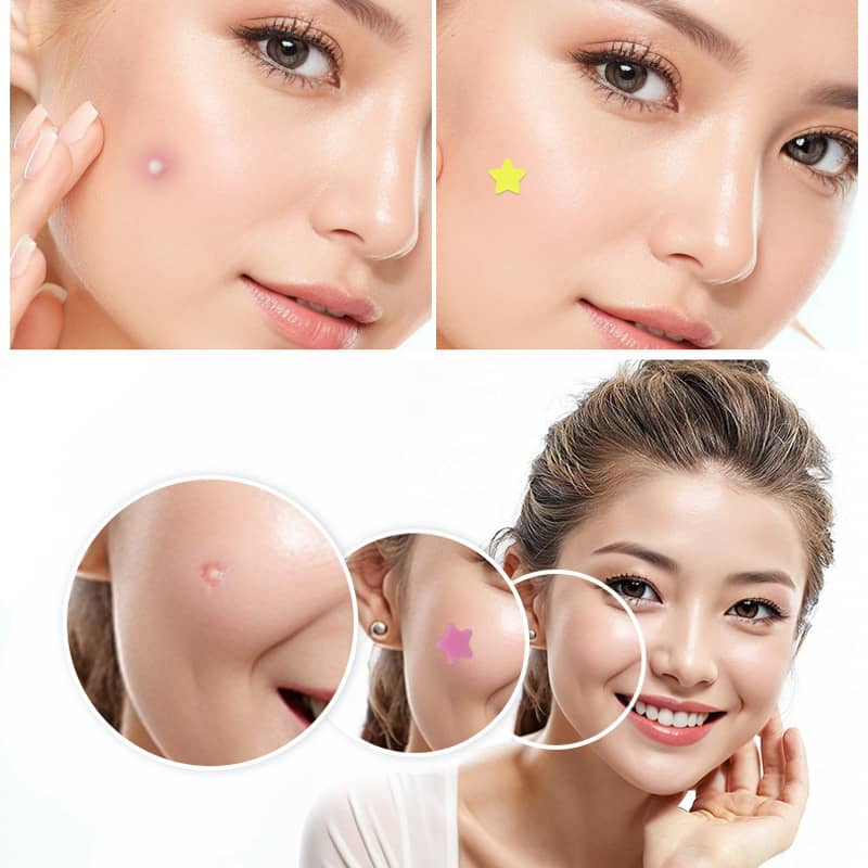 Jual Colored Pimple Stickers Invisible Pimple Marks Acne Patch | Shopee ...