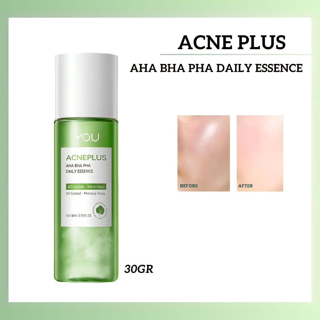 Jual You Acne Plus AHA BHA PHA Daily Essence 80ml / Acne Treatment ...