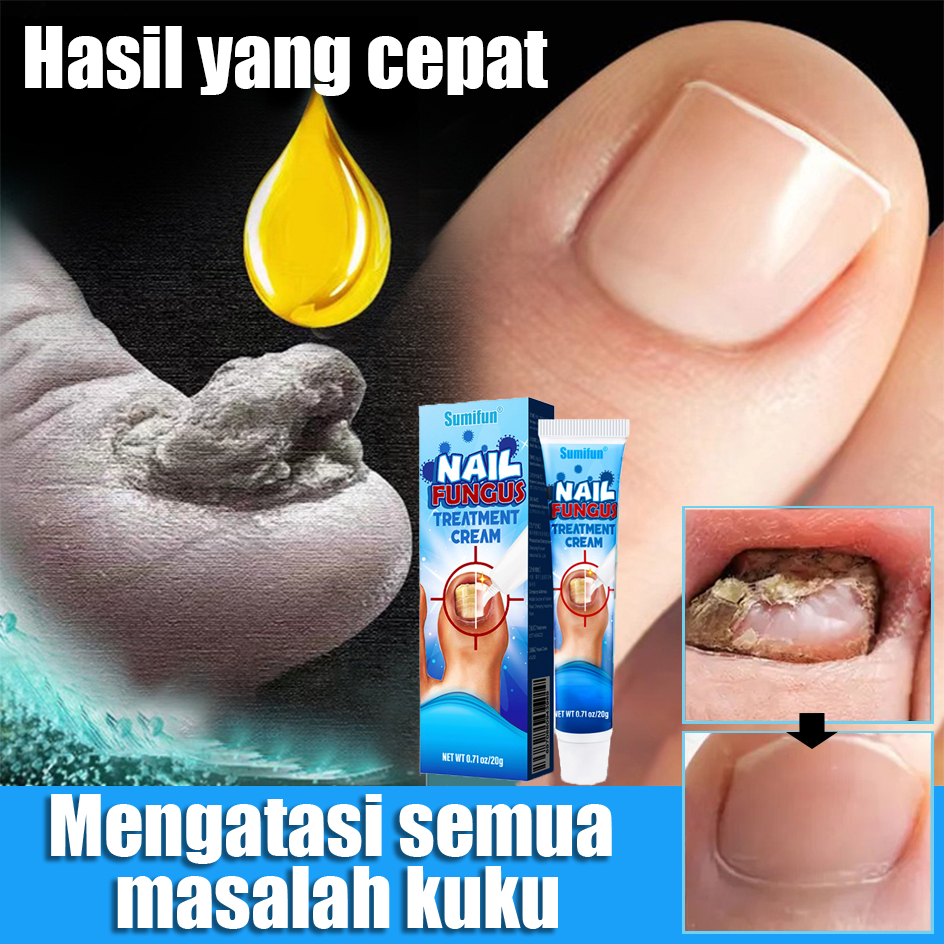 Jual Obat jamur kuku salep jamur kuku obat kuku rusak dan jamur obat ...
