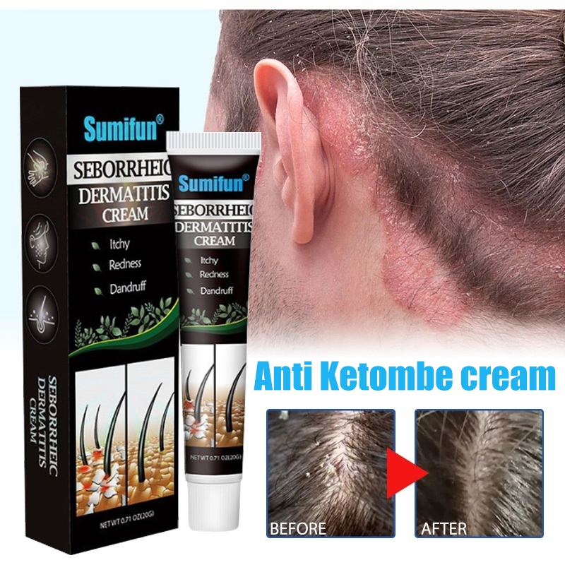 Jual Krim Dermatitis Seboroik 20g Anti Ketombe Cream Seborrheic Skin ...