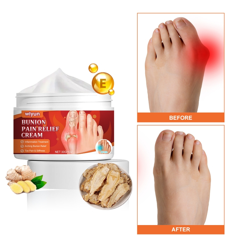 Jual 30g Obat Asam Urat Paling Ampuh Gout Cream Gout Treatment Joint ...