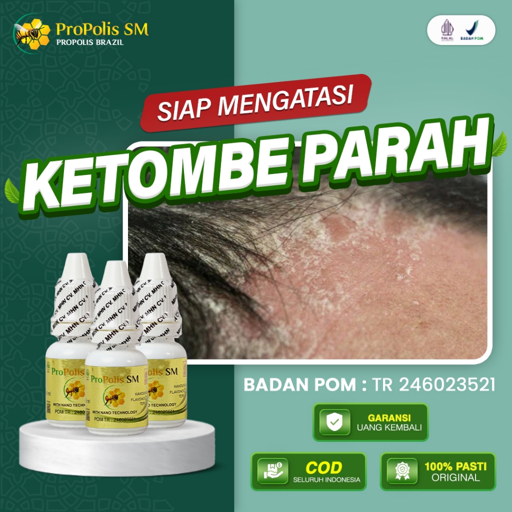 Jual Obat Ketombe Parah Di Rambut Kulit Kepala Berkerak Bersisik Jamuran Dermatitis Psoriasis ...