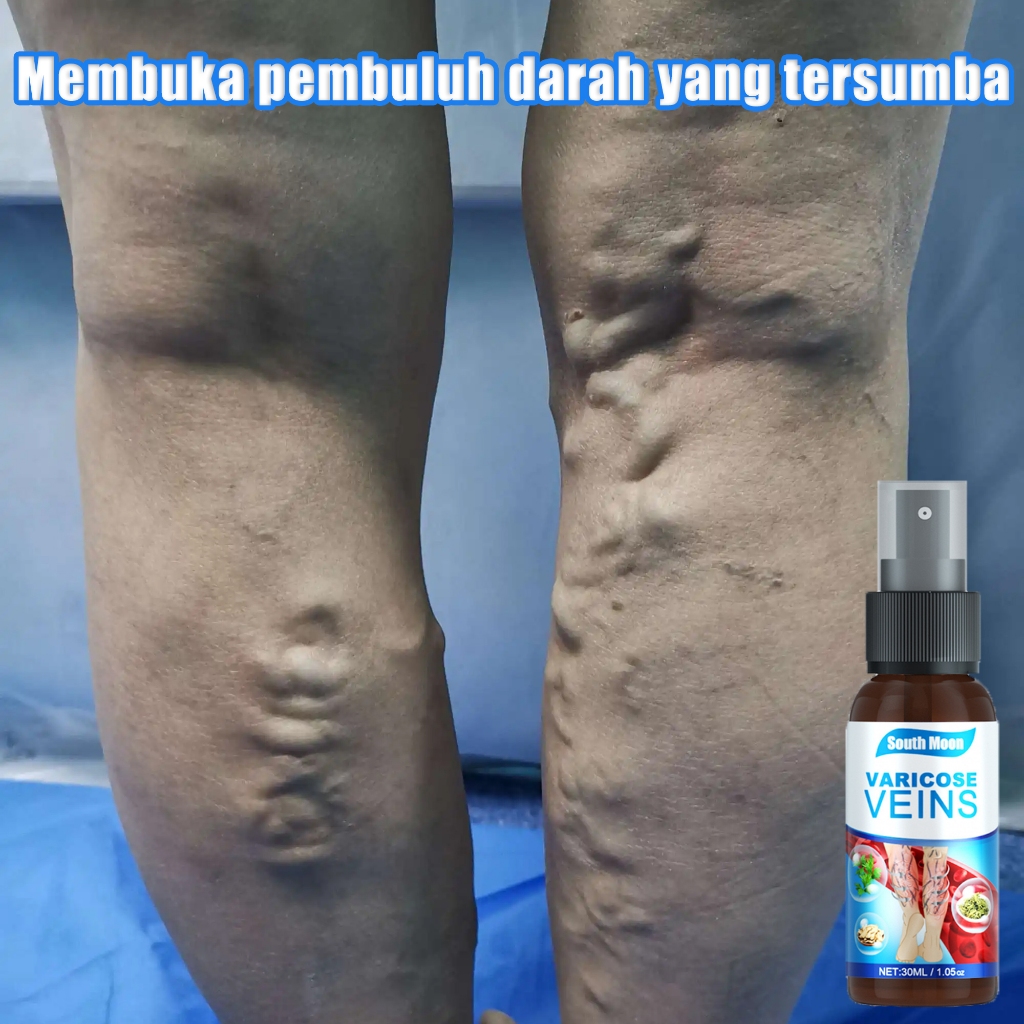 Jual Varicose Veins Spray Obat Varises Salep ampuh salep varises ...