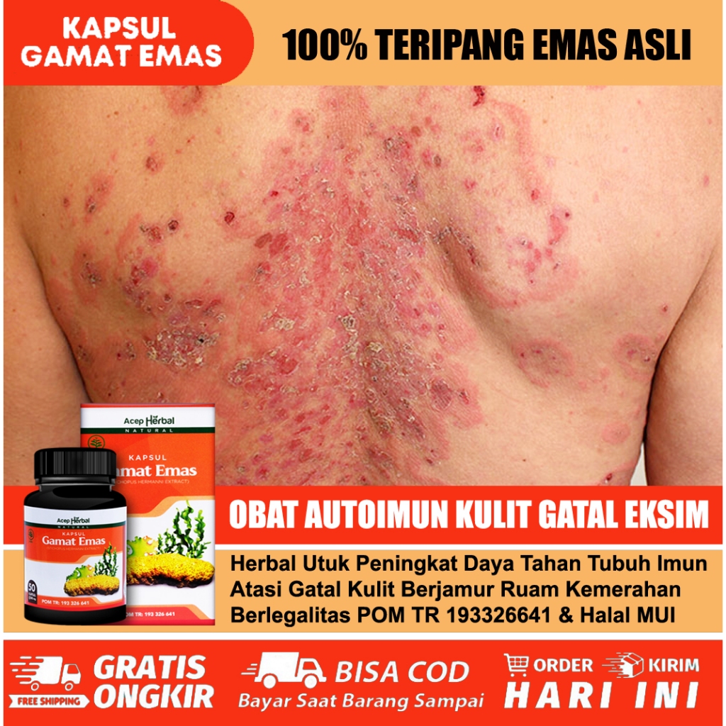 Jual Obat Autoimun Kulit Gatal Lupus Sering Sakit | Meningkatkan Daya ...