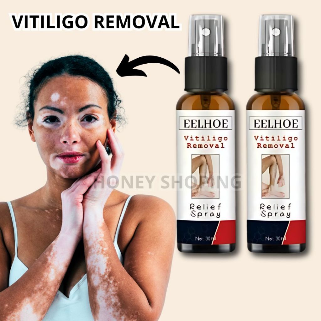 Jual VITILIGO REMOVAL Spray Vitiligo Bercak Putih / Kulit Belang Putih ...