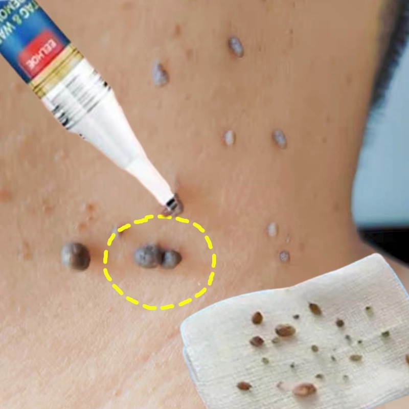 Jual Penghilang Tahi Lalat Penghilang Kutil Skin Tag Remover Obat kutil ...