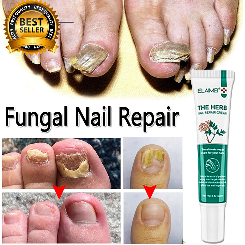 Jual obat kuku jamur dan rusak salep kuku jamur dan rusak obat kuku ...