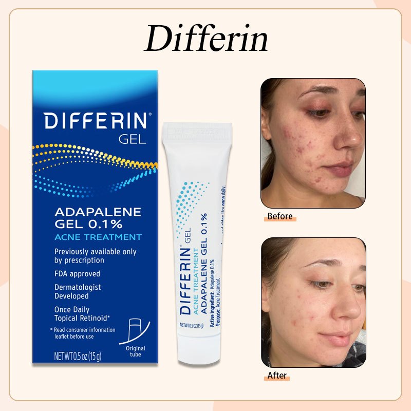 Jual Differin Acne Treatment Gel 15 gram / Acne Treatment / Adapalene ...
