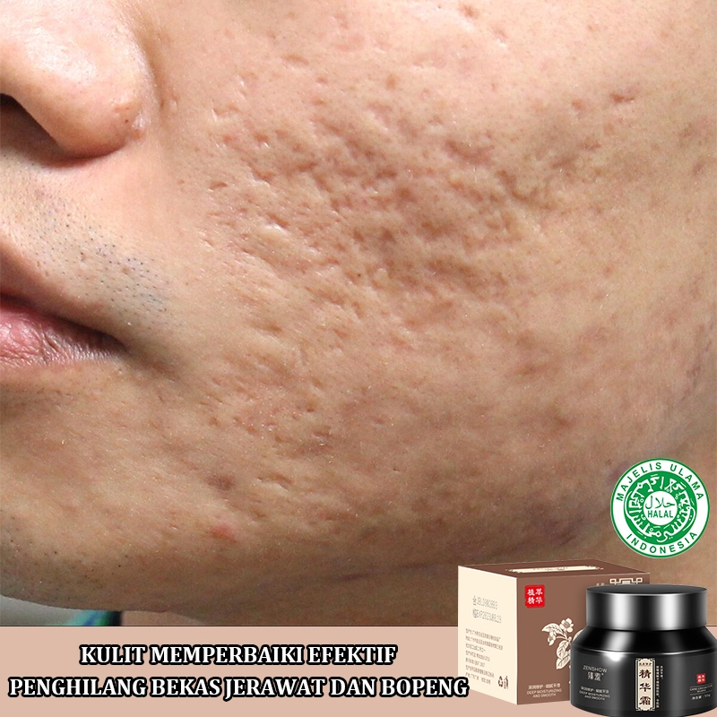 Jual penghilang bekas jerawat penghilang bopeng Krim cream wajah 50g ...