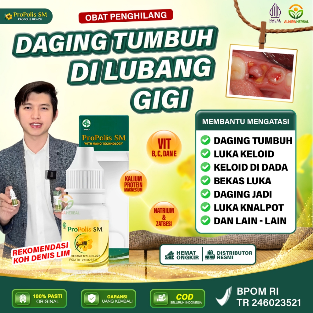 Jual Obat Polip Gigi, Penghilang Daging Tumbuh, Polip Gusi, Gusi ...