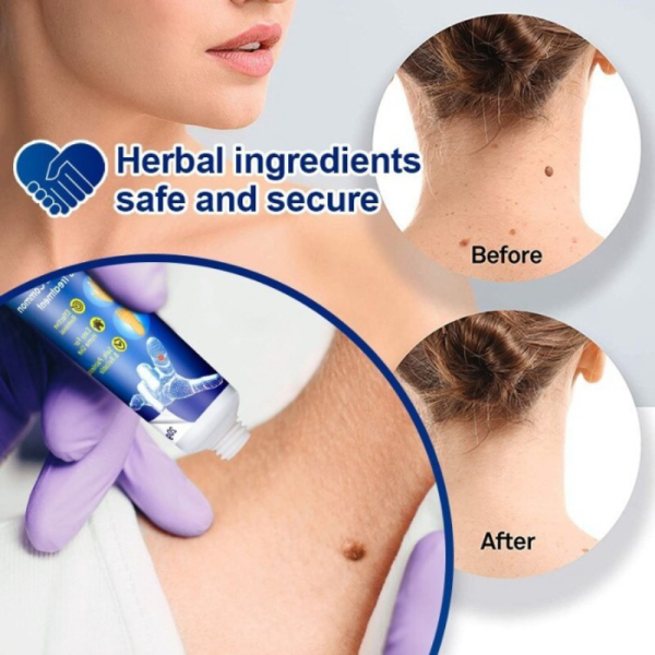 Jual Promo 100ORI- Salep Obat Penghilang Kutil-Skin Tag-Papiloma-Daging ...