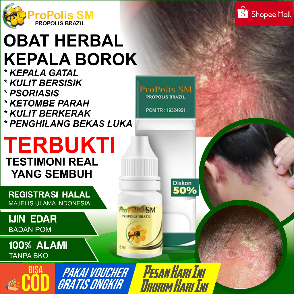 Jual Obat Koreng Di Kepala Borok di Kulit Kepala Psoriasis Kulit Bersisik Kering Luka Borok ...