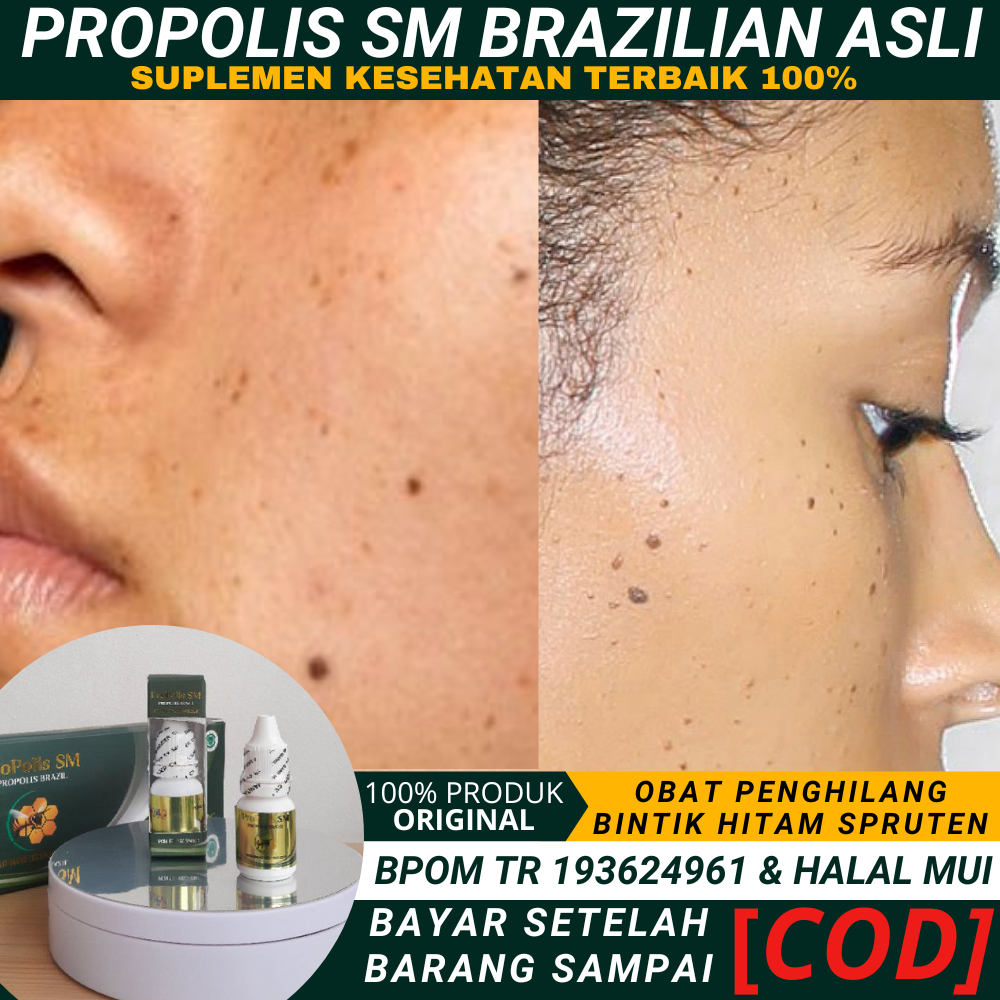 Jual Propolis SM Untuk Menghilangkan Spruten di Wajah dan Leher, Bintik ...