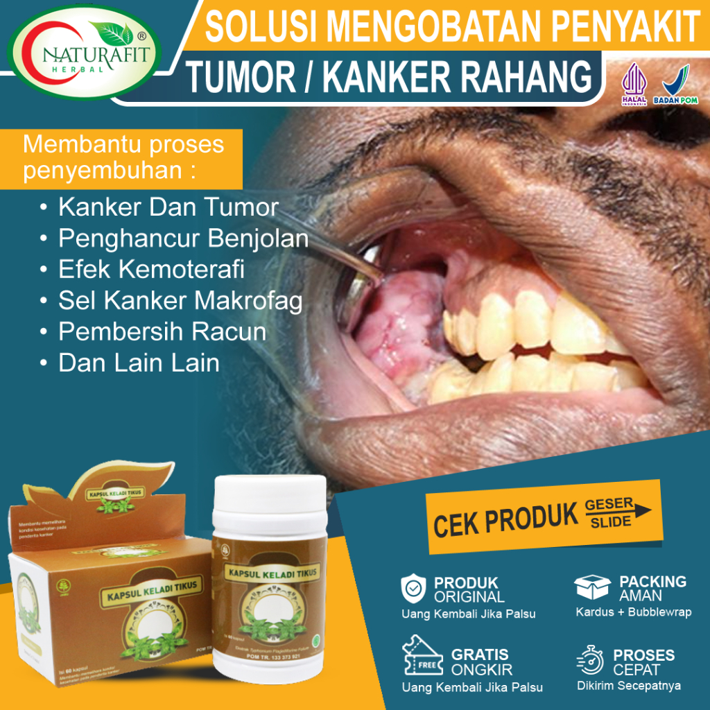 Jual Obat Tumor Rahang Paling Ampuh, Benjolan di Rahang Mulut, Kanker ...