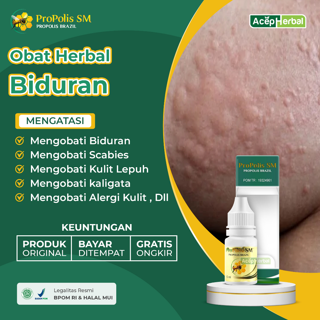Jual Obat Biduran Alergi Dingin Kaligata Menahun Kulit Gatal Kemerahan ...