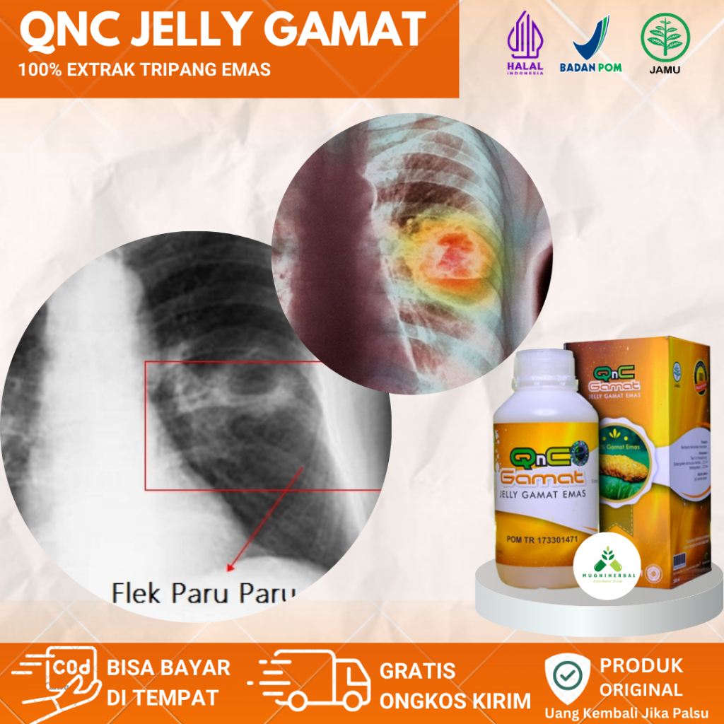Jual Qnc Jelly Gamat Obat Flek Paru Paru, TBC, Radang Paru Paru, Paru ...