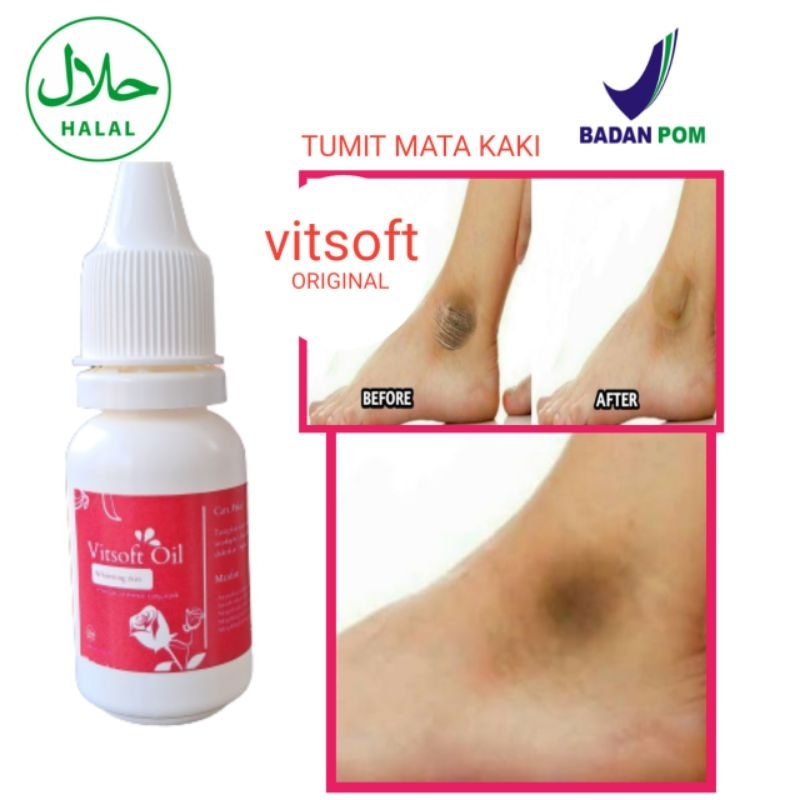 Jual PEMUTIH TUMIT MATA KAKI DALAM 5 HARI OBAT TETES VITSOFT | Shopee ...