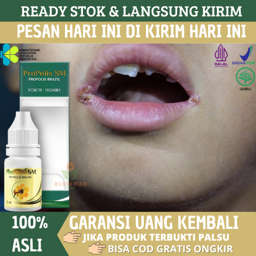 Jual Obat Luka Di Sudut Bibir Anak, Obat Oles Pinggir Mulut / Bibir Luka, Obat Angular Cheilitis ...