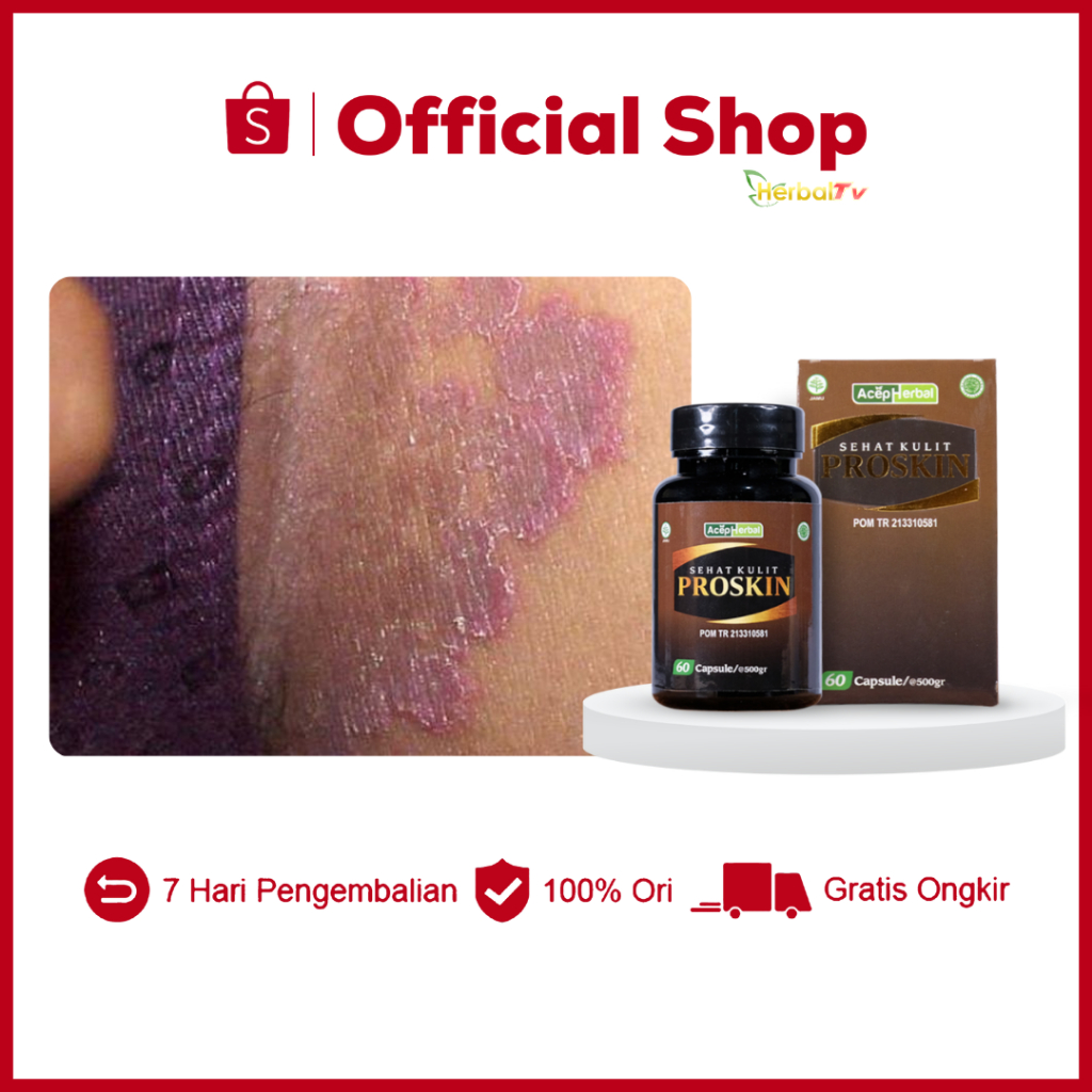 Jual PROSKIN Obat Kulit Gatal Selangkangan Hitam Gatal Eksim dan Jamur ...