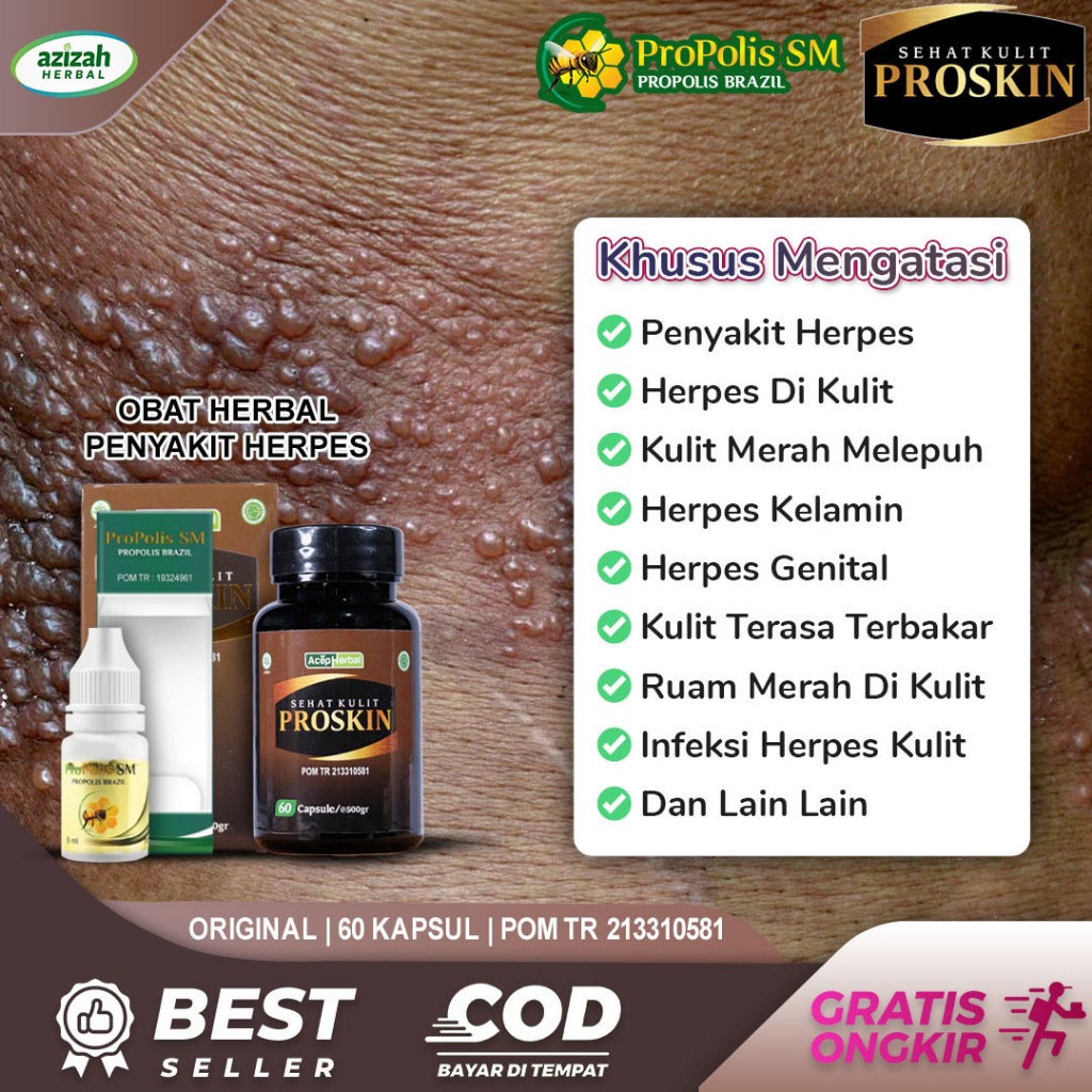 Jual Obat Herpes Zoster Ruam Merah Di Kulit Melepus Bentol Bruntusan ...
