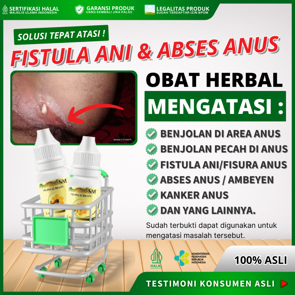 Jual Propolis SM - Obat Fistula Ani, Obat Benjolan Berisi Nanah Di Area ...