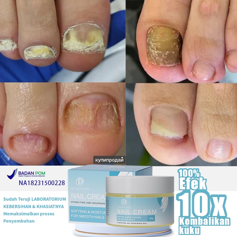 Jual [BPOM] DODOYURI Perawatan kuku Obat jamur kuku Obat kuku jamur dan ...