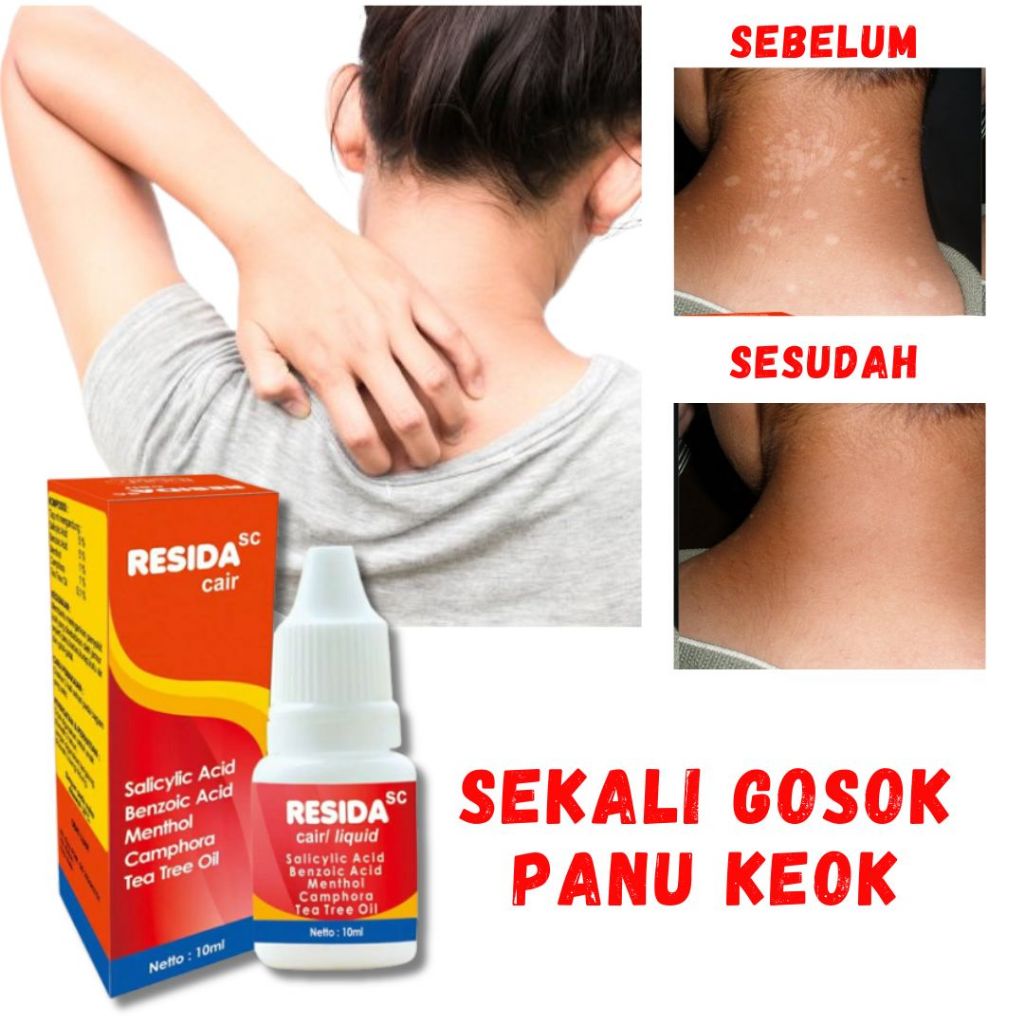 Jual Obat Panu Paling Ampuh 100% Resida Salep Kurap Kadas Kudis Gatal ...