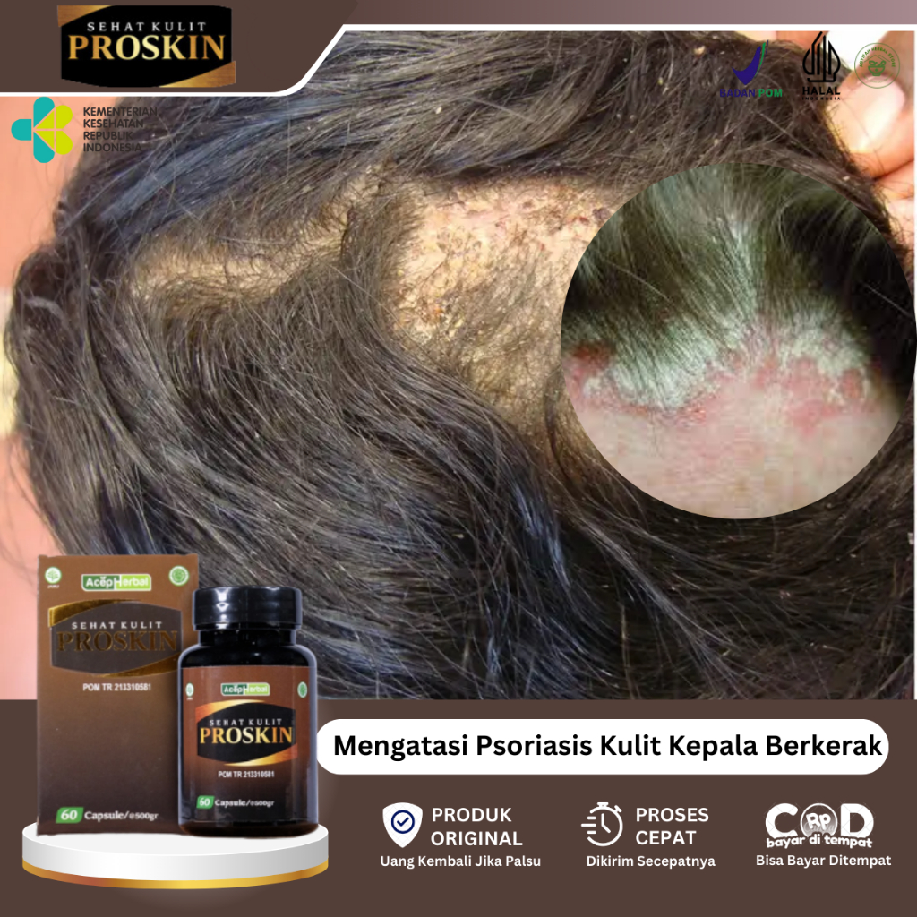 Jual Obat Kulit Kepala Kering Berkerak, Obat Psoriasis, Obat Gatal Kulit Kepala Jamur, Obat ...
