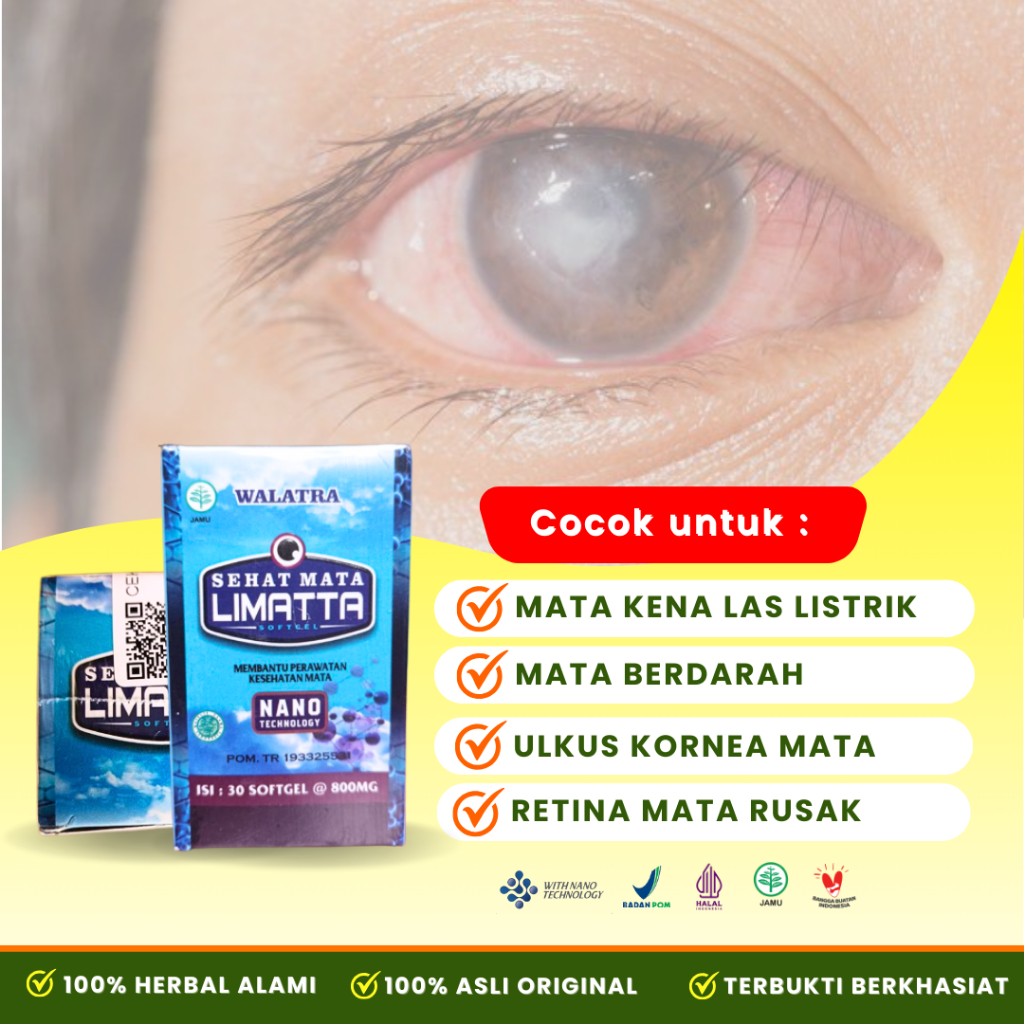 Jual Obat Mata Kena Asap Las Listrik, Mata Luka Berdarah Herbal LIMATTA ...