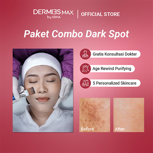 Jual Dermies Max Paket Combo untuk Dark Spot | Shopee Indonesia
