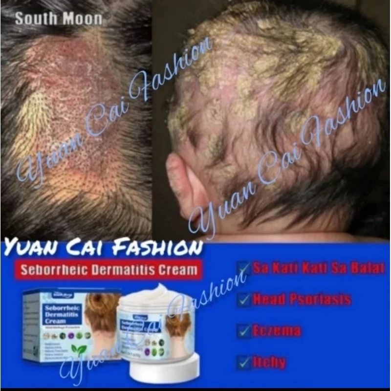 Jual 50g Seborrheic Dermatitis Cream, Krim Kulit Gatal Non-iritasi ...