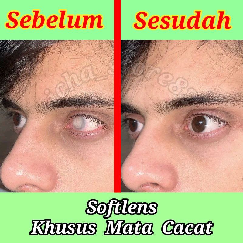 Jual Softlens prosthetic iris Brown DIAMETER 14mm Masa pemakaian 1 ...
