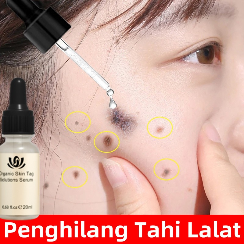 Jual Penghilang Tahi Lalat Penghilang Kutil Skin Tag Remover Flek Dan ...