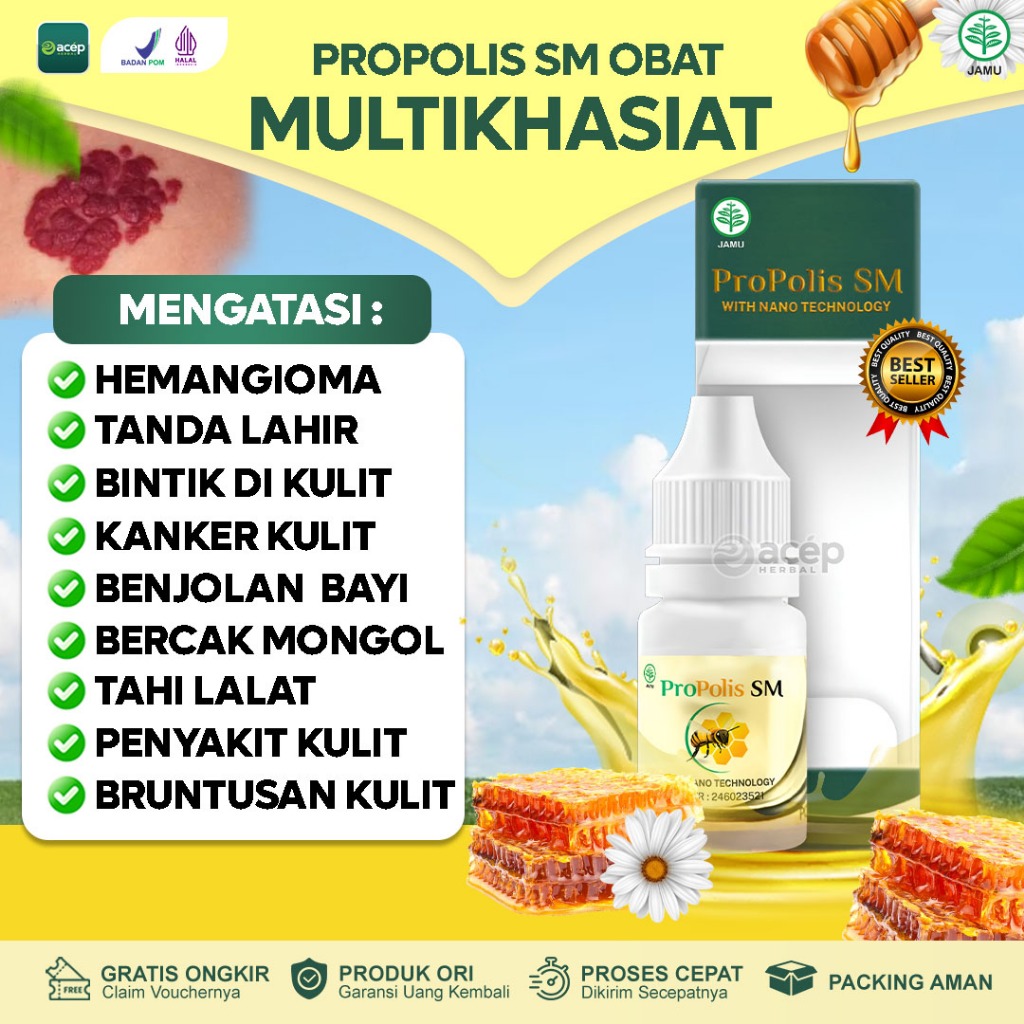 Jual Obat Hemangioma Penghilang Tanda Lahir Coklat Dan Merah Di Wajah ...