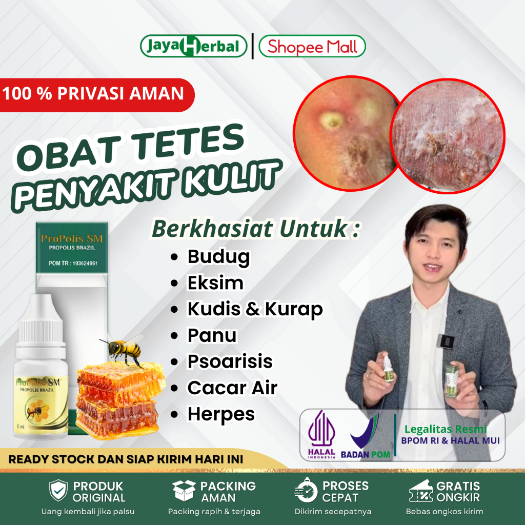 Jual Obat Oles Budug, Eksim, Kurap, Kudis, Panu, Psoarisis, Cacar ...