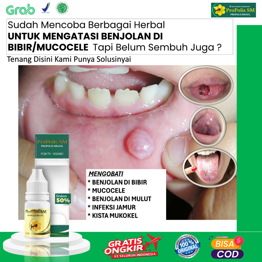 Jual Obat Tetes Bercak Putih Di Lidah Mulut Bau Busuk Mucocele benjolan ...