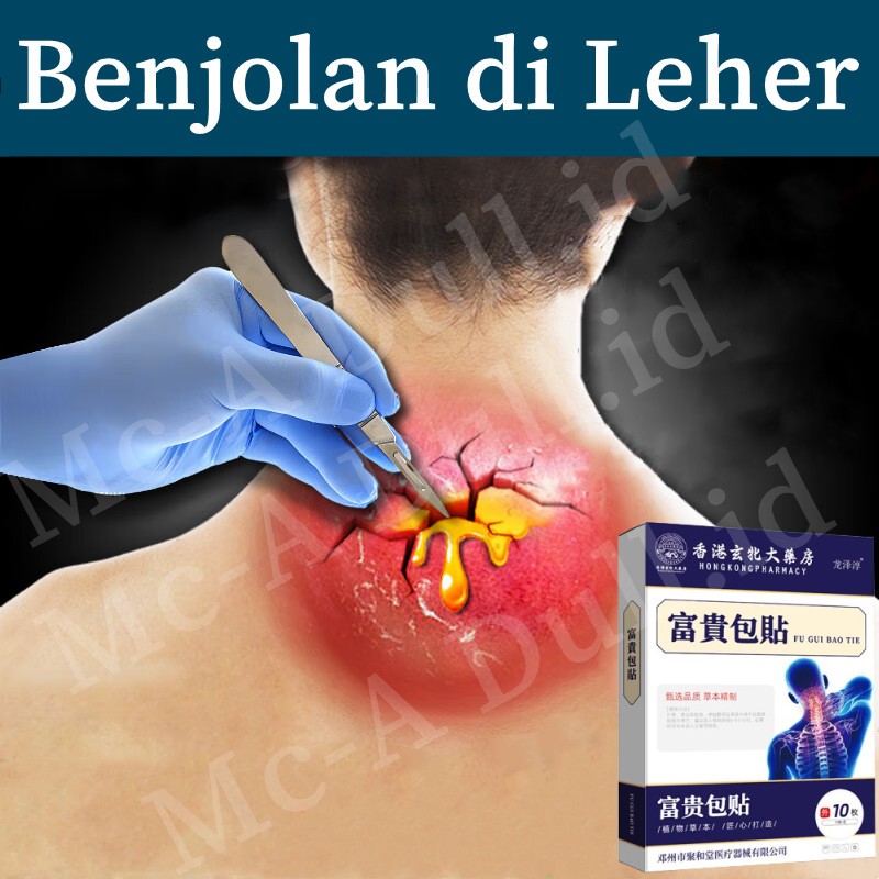 Jual Benjolan di Leher Koyo Leher gondok kelenjar getah bening kista ...