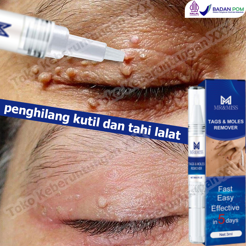 Jual Obat Penghilang Kutil Penghilang kutil di wajah Penghilang tahi ...